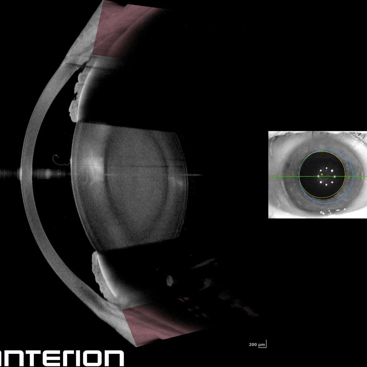 Cataract App Heidelberg Engineering