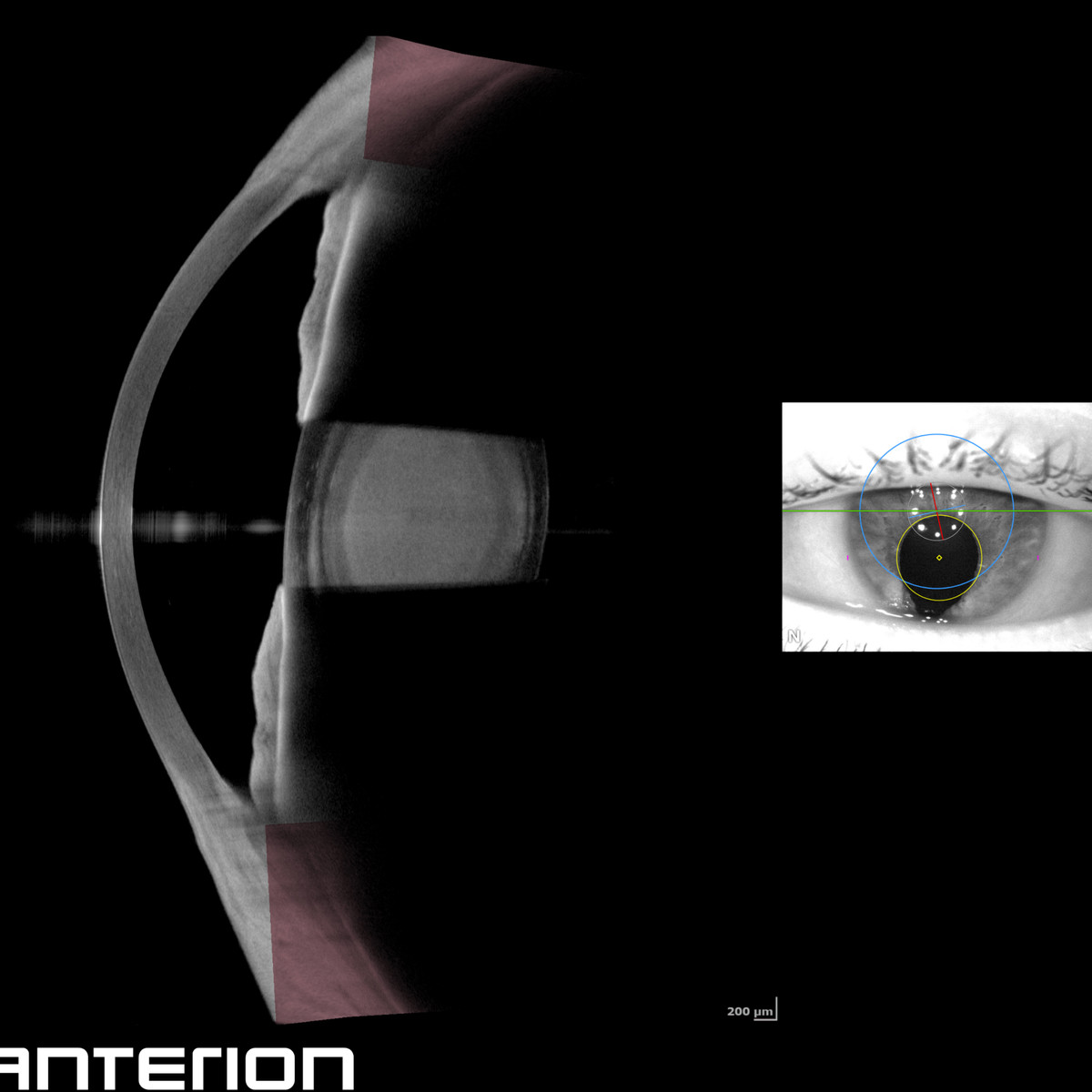 Cataract App - Multi-modal imaging platform optimized for the anterior ...