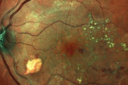 Medical Devices for Ophthalmologists / Optometrists | Heidelberg ...