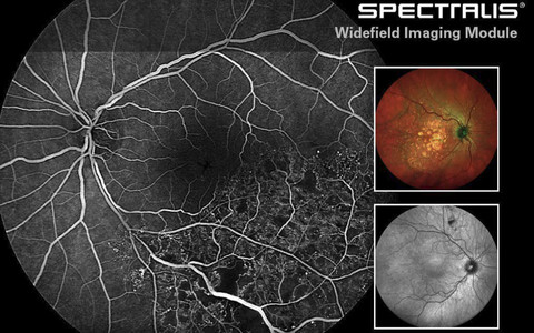 Downloads - SPECTRALIS Widefield fundus and OCT | Heidelberg Engineering