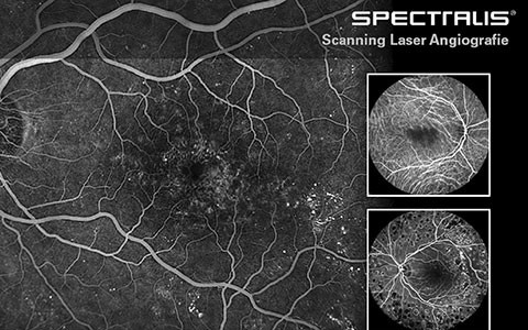Downloads - Hochauflösende SPECTRALIS Scanning Laser Angiografie ...